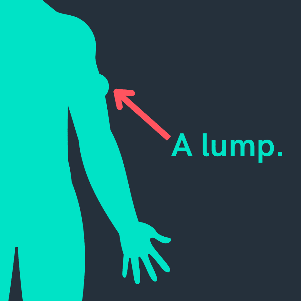 Measuring and tracking a lump | Sarcoma UK