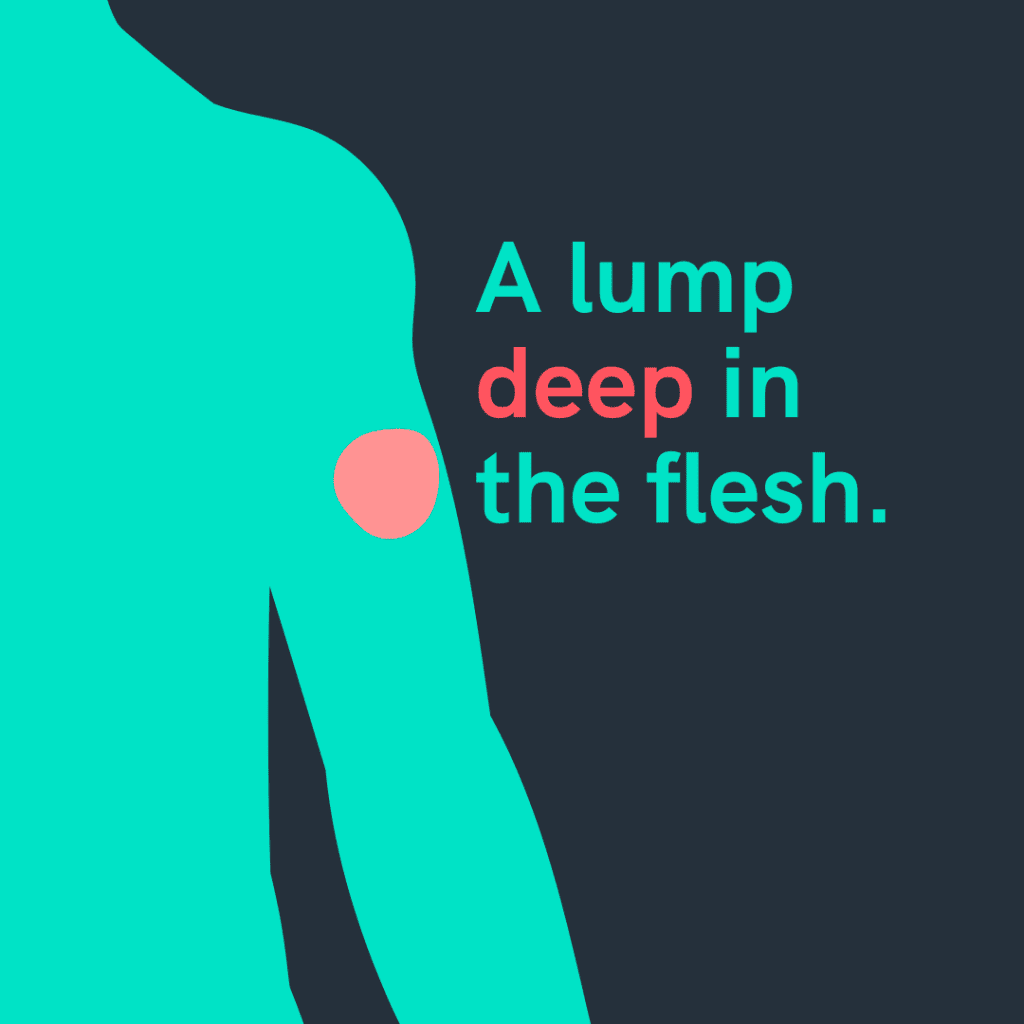 Measuring and tracking a lump | Sarcoma UK